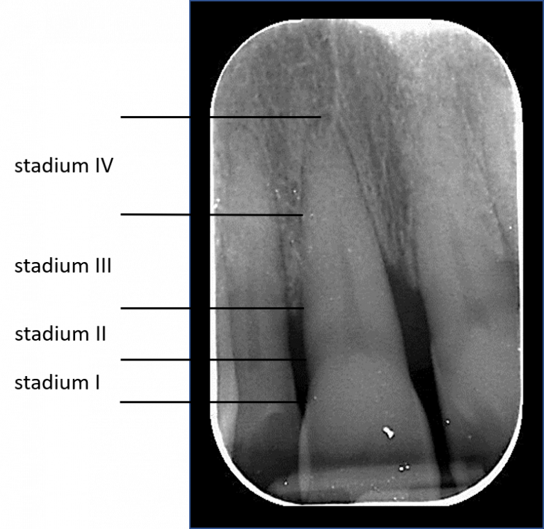 het nieuwe internationale classificatiesysteem staging and grading