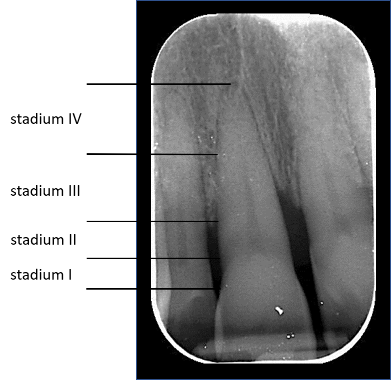 het nieuwe internationale classificatiesysteem staging and grading